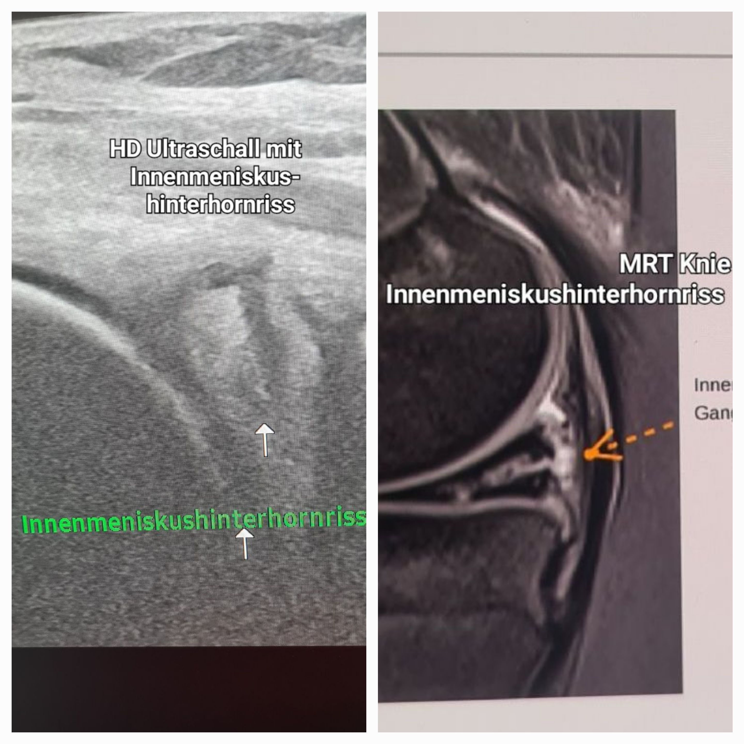 HD Ultraschall mit Darstellung eines Innenmeniskushinterhornrisses ...